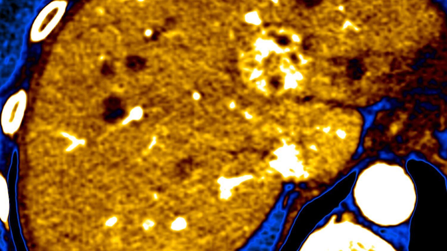 Cardiology Advanced Visualization | GE HealthCare (Thailand)