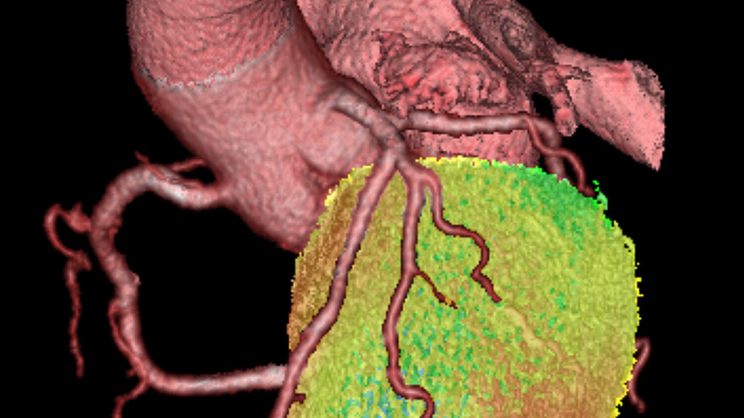 Cardiology Advanced Visualization | GE HealthCare (Thailand)