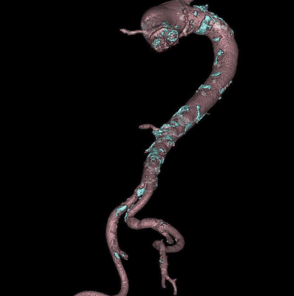 Valve Planning Protocol | GE HealthCare (Thailand)